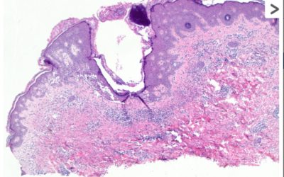 Projects | GROVERs disease TREATMENT, skin rash,